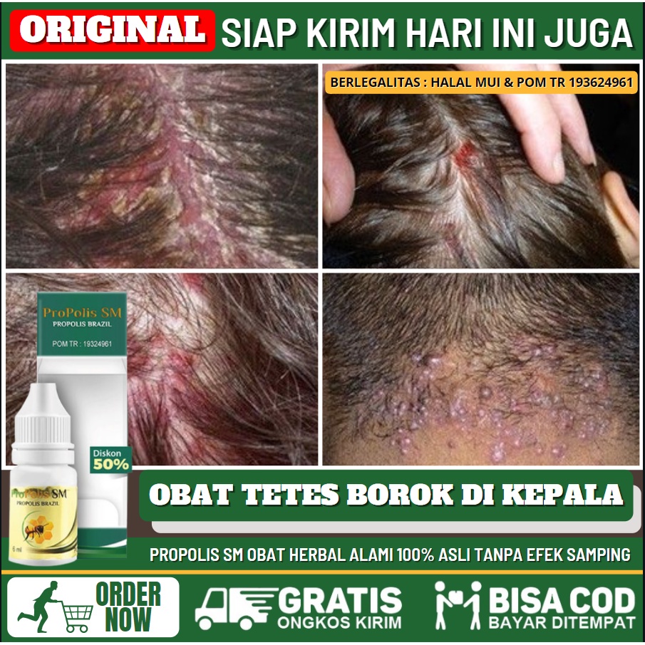 Jual Obat Cair / Salep Kulit Kepala Borok 100% Asli Alami, Obat Kulit Kepala Gatal Gatel ...