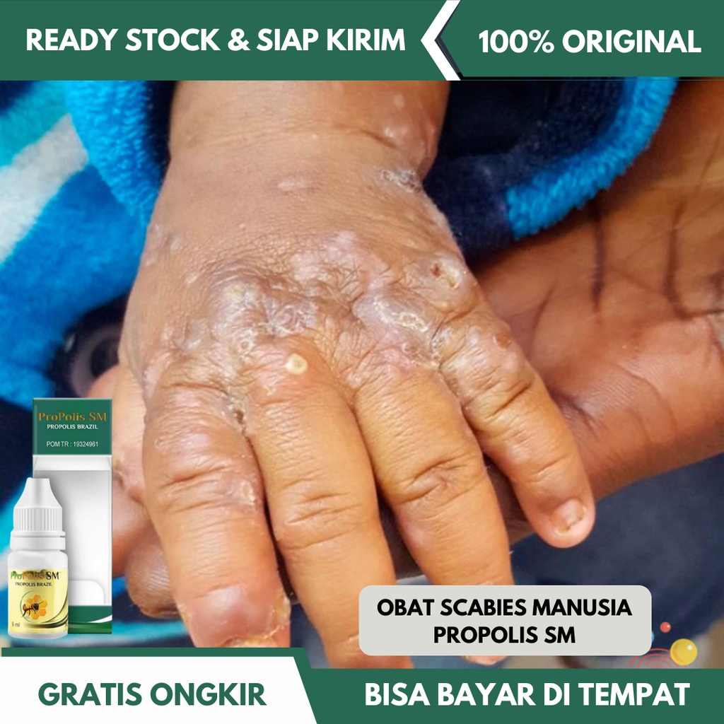 Jual Obat Oles Scabies Manusia, Obat Pembasmi Kutu Sekabies Kudis Gudik ...
