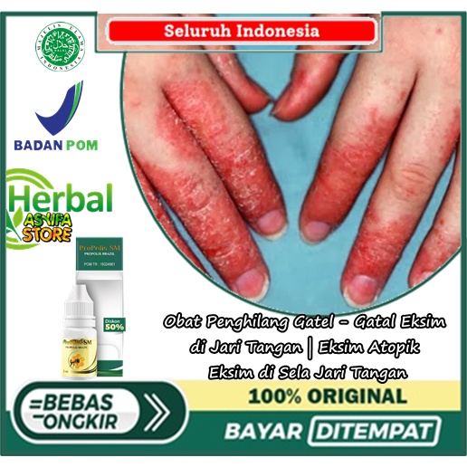 Jual Obat Penghilang Gatel - Gatal Eksim di Jari Tangan | Eksim Atopik ...