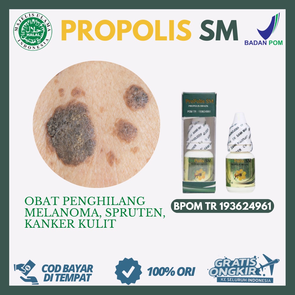 Jual Obat Penghilang Kanker Kulit Melanoma, Melanosit, Menghilangkan ...