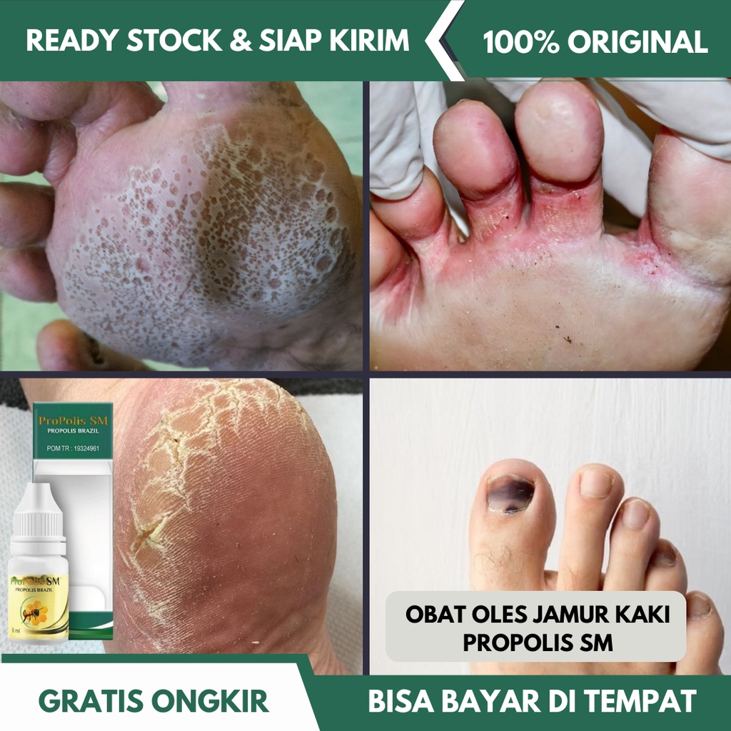 Jual Obat Jamur Kaki, Infeksi Jamur pada Kulit Kaki, Tinea Pedis, Kuku ...