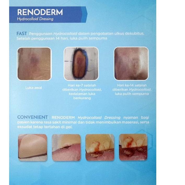Jual Kekinian Renoderm Hydrocolloid Dressing 10cm x 10cm | Shopee Indonesia