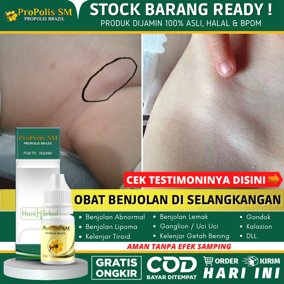 Jual Obat Penghilang Benjolan di Selangkangan Sebelah Kanan / Kiri ...