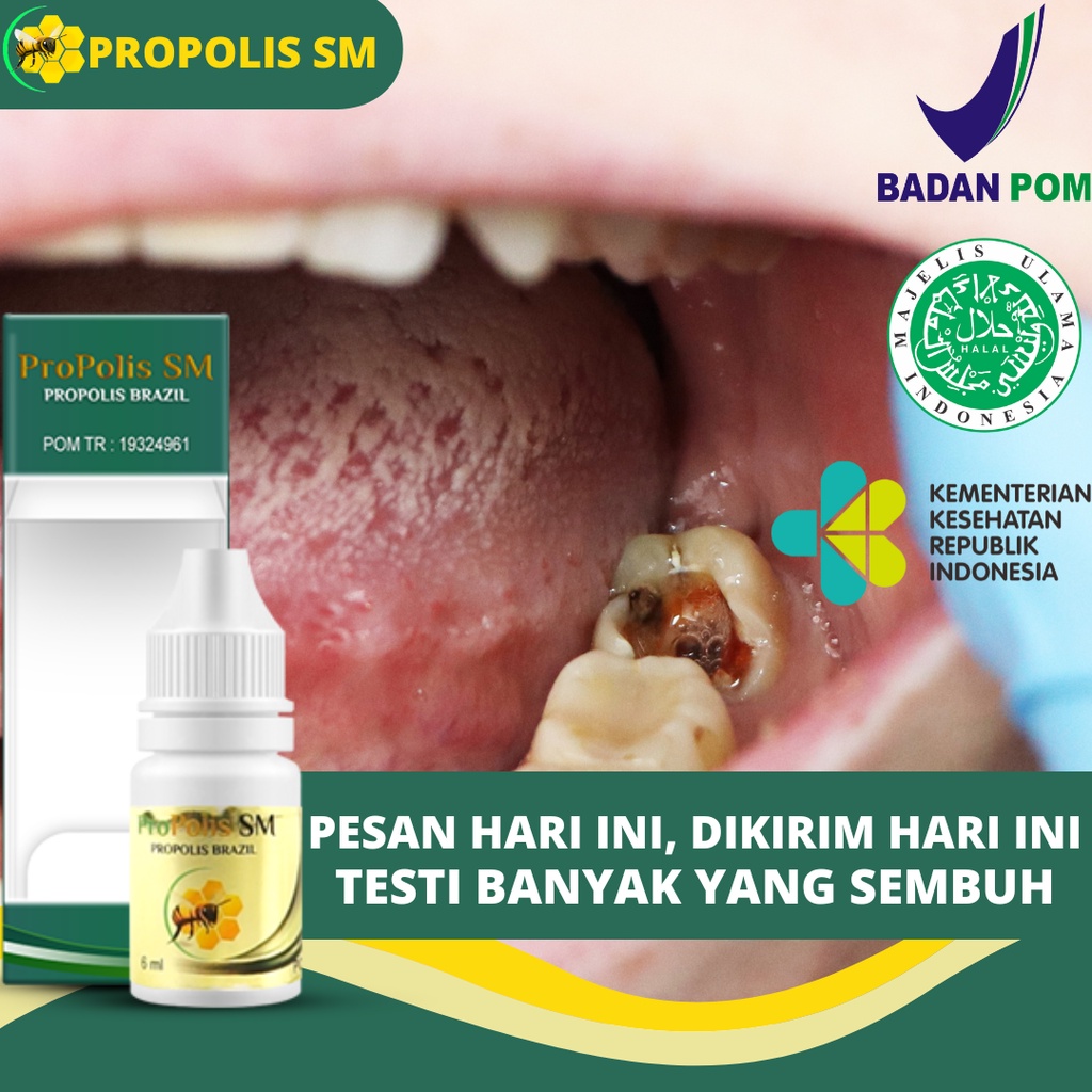 Jual Obat Gigi Bolong, Obat Gigi Goyang, Obat Akar Gigi, Obat ...