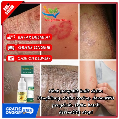 Jual Obat penyakit kulit eksim, Penghilang, eksim kering, dermatitis ...