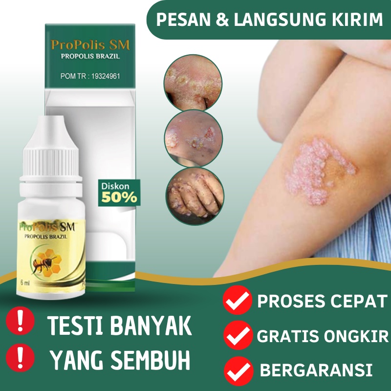 Jual Obat Budug dan gatal, Obat Scabies manusia, Obat Scabies / kudis ... Jual Obat Budug dan gatal, Obat Scabies manusia, Obat Scabies / kudis ...