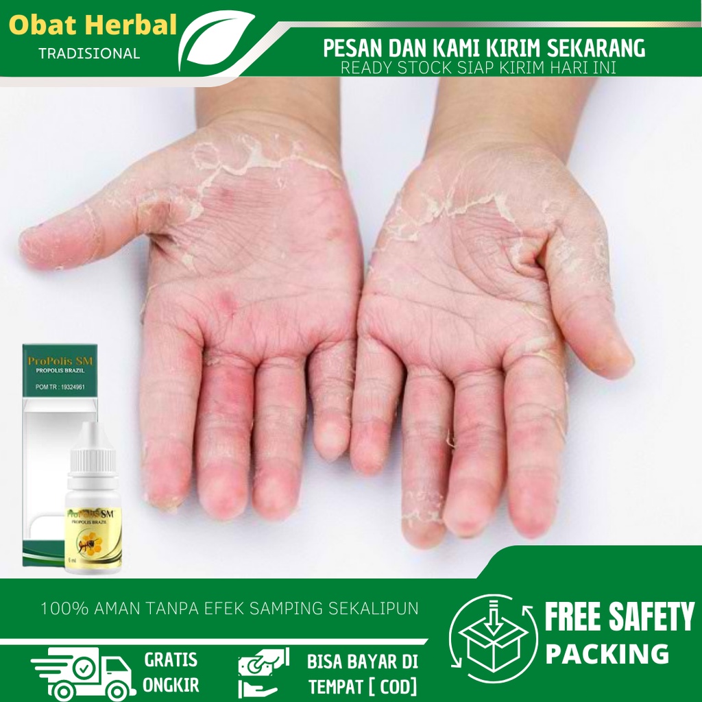 Jual Obat Kulit Telapak Tangan Mengelupas, Obat Kulit Jari Tangan ...