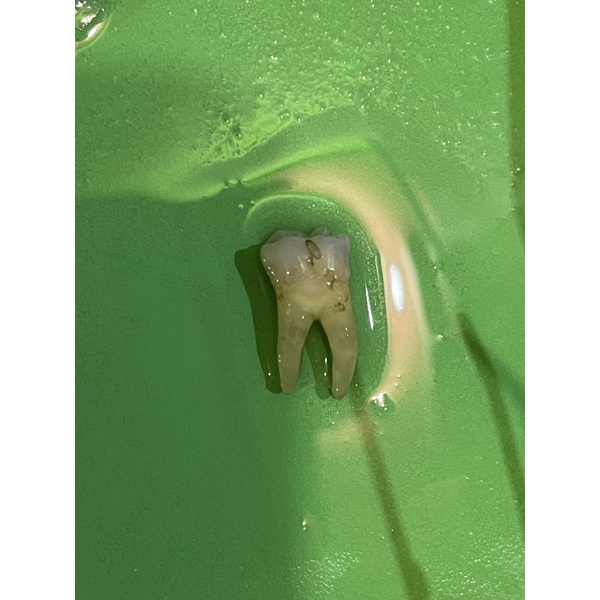 Jual Jual Gigi Praktikum gigi asli manusia / gigi MOLAR dengan DEFFECT ...