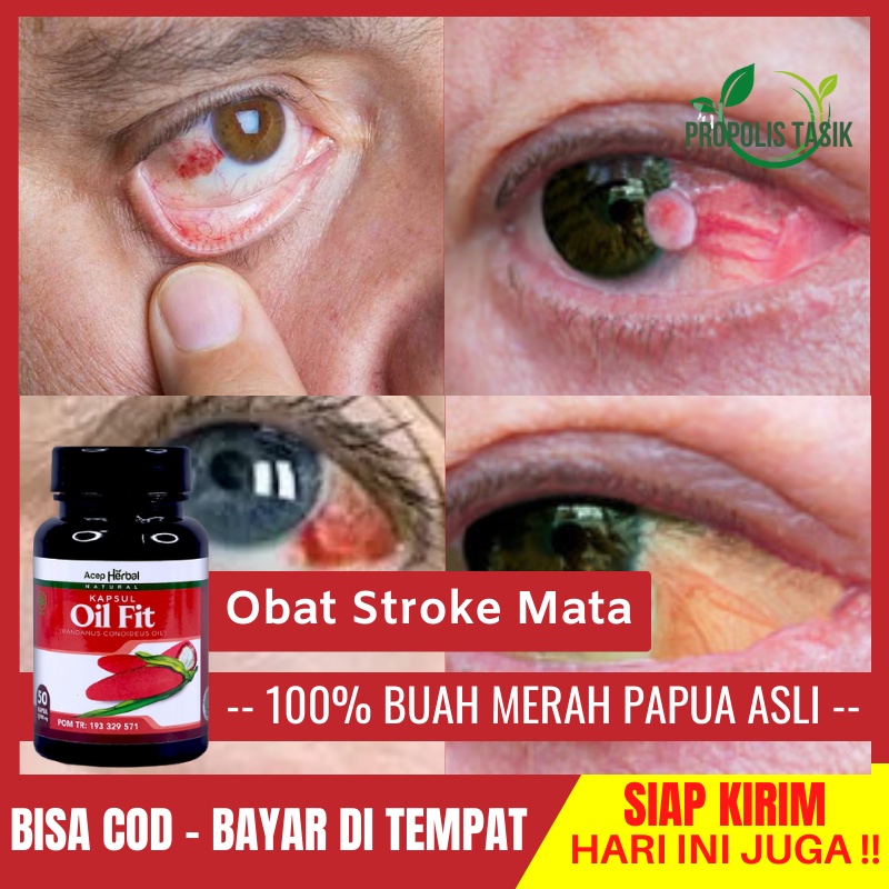 Jual Obat Stroke Mata Penyumbatan Pada Pembuluh Darah Di Retina Dengan ...