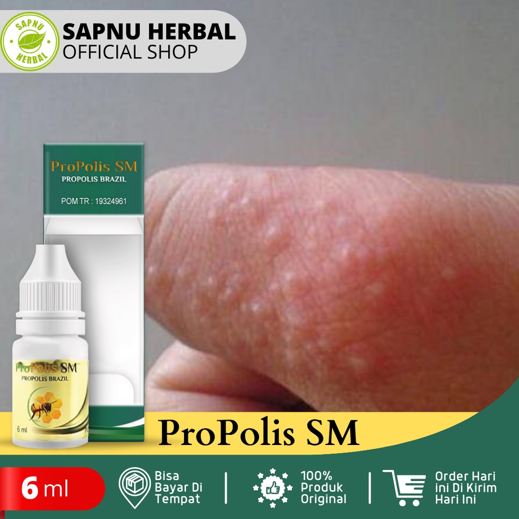 Jual Obat Gatal Berair Di Jari Tangan & Kaki, Obat Kutu Air Ruam Dan ...