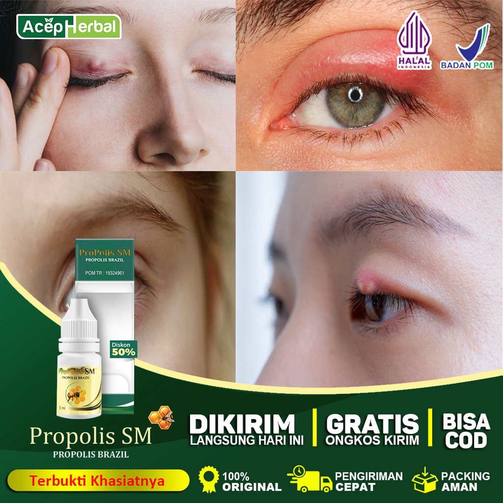 Jual Obat Mata Bintitan Timbilan Mata Timbilan Bernanah Mata Kalazion ...