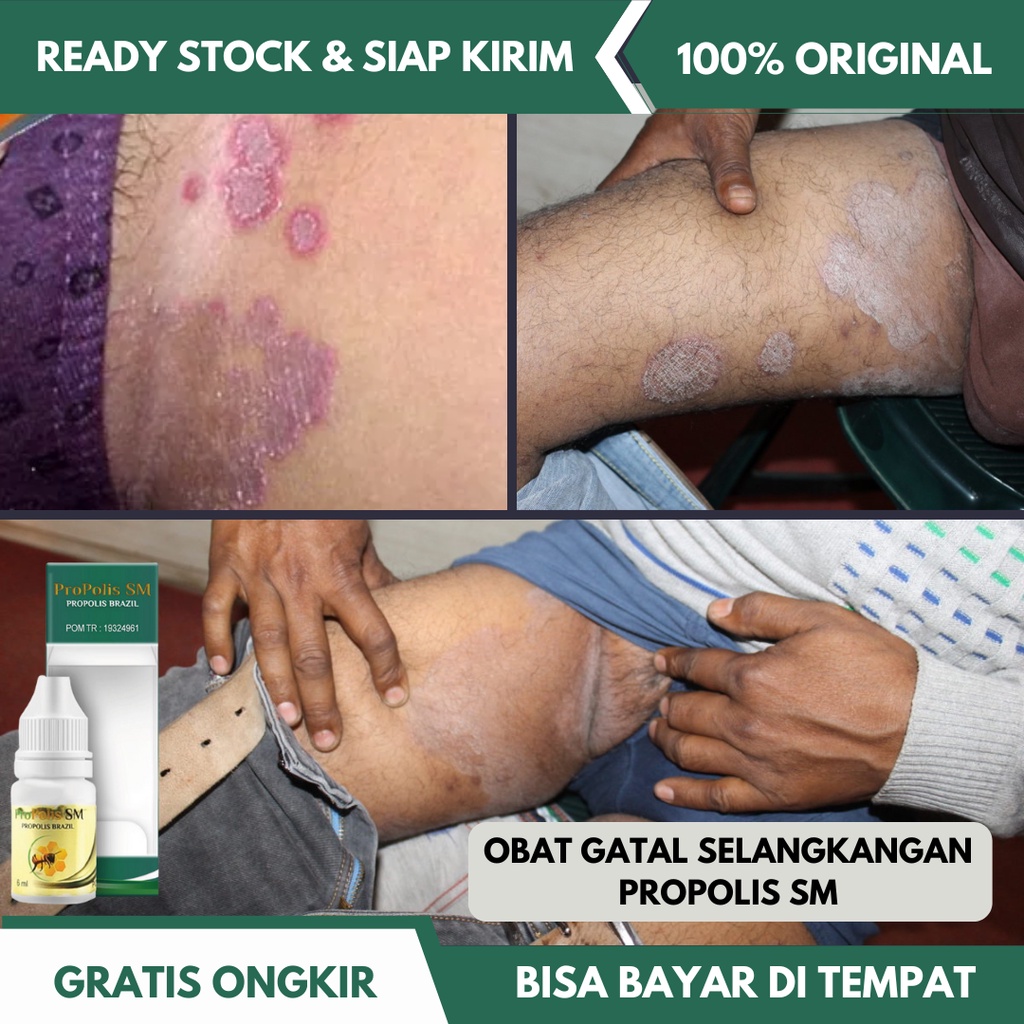 Jual Obat Gatal Selangkangan, Obat Gatal Jamur Di Selangkangan, Sakit ...