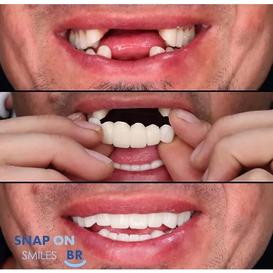 Jual DENTAL Paket gigi palsu atas bawah snap on smile Gigi Palsu Atas ...