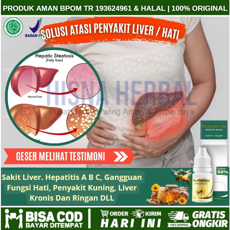 Jual Obat Liver Perut Bengkak, Kaki Bengkak, Sakit Sesak, Obat Liver ...