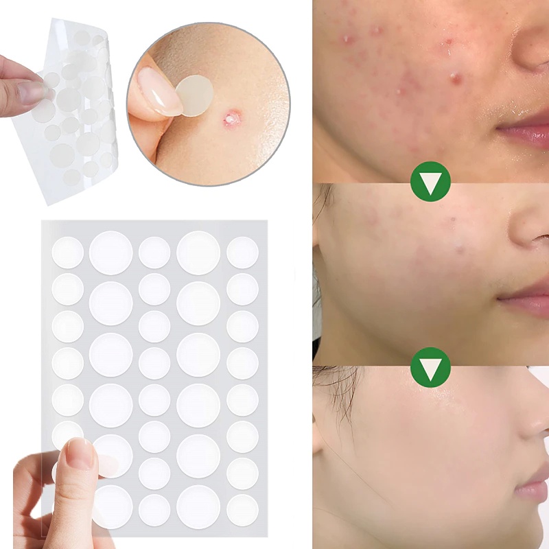 Jual Sticker Jerawat Acne Patch Invisible Penghilang Jerawat Kempes ...