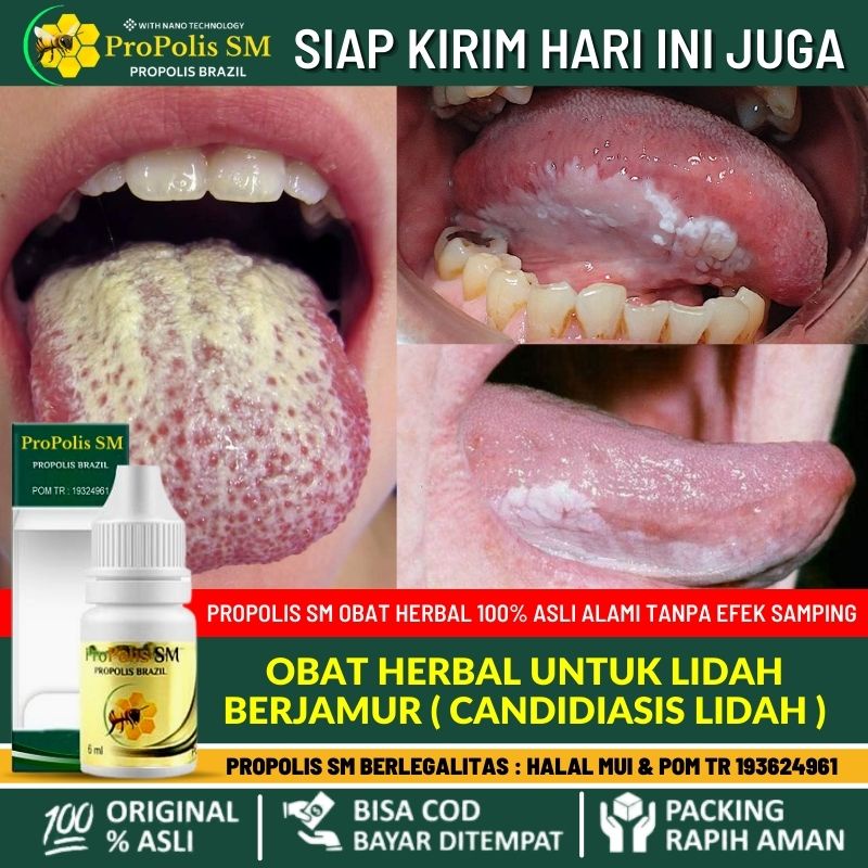 Jual Obat Kumur - Kumur Penghilang Kandidiasis Mulut, Obat Lidah ...