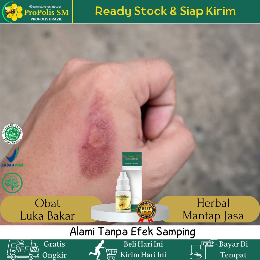 Jual Obat Oles Luka Bakar, Obat Melepuh Akibat Luka Bakar, Obat Herbal ...