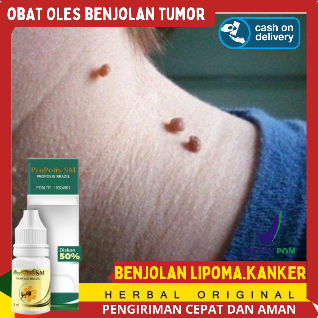 Jual cara mengatasi bisul yang berpindah-pindah, Benjolan di kepala ...