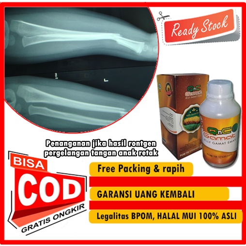 Jual Penanganan jika hasil rontgen pergelangan tangan anak retak | Obat ... Jual Penanganan jika hasil rontgen pergelangan tangan anak retak | Obat ...