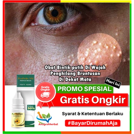 Jual Obat Bintik putih Di Wajah, Herbal Penghilang Bruntusan Di Dekat ...