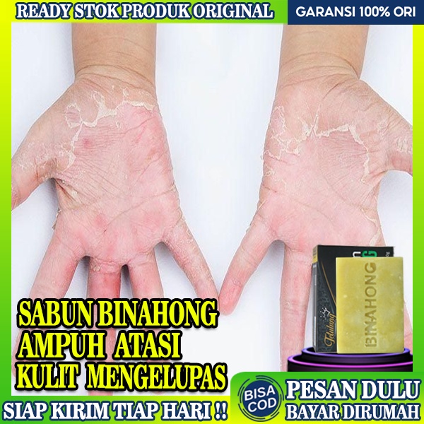 Jual Sabun Kulit Kering dan Gatal, Obat Kulit Mengelupas - Sabun ...
