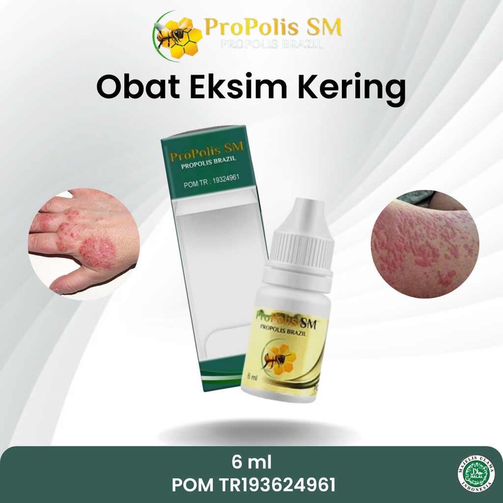 Jual Obat Eksim Menahun, Obat Exim Kering, Obat Eksim Kering, Obat ...