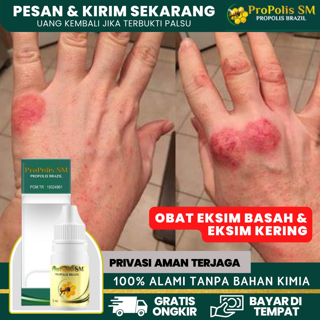 Jual Obat Eksim Kering, Obat Eksim Basah, Gatal Di Kulit, Gatal-Gatal ...