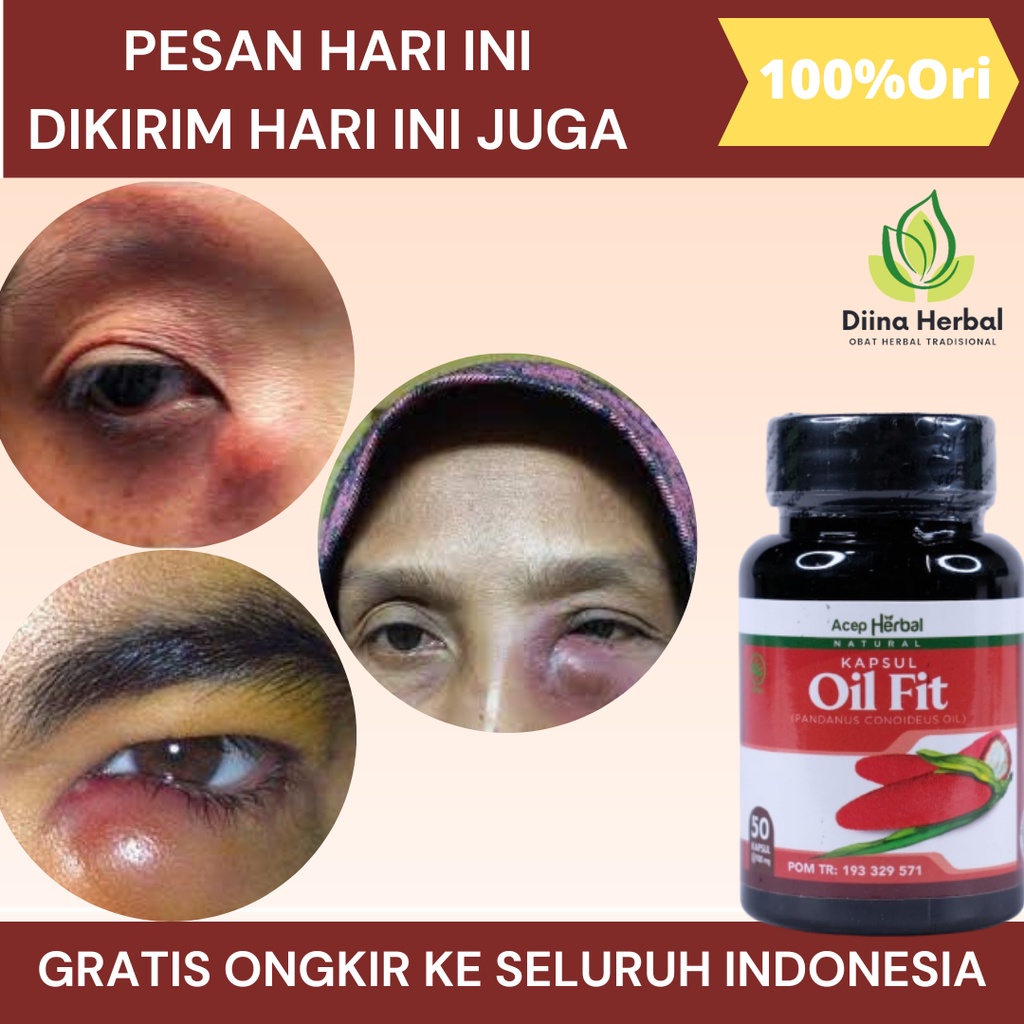 Jual Obat Radang Kelenjar Air Mata, Obat Dakrioadenitis, Obat Mata ...