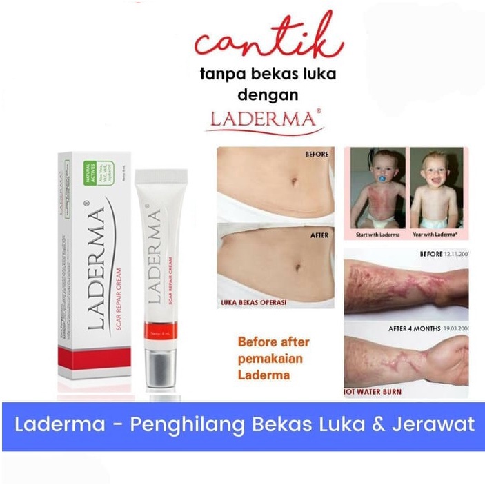Jual LADERMA SCAR REPAIR CREAM PENGHILANG BEKAS LUKA DAN BEKAS JERAWAT 8ml | Shopee Indonesia