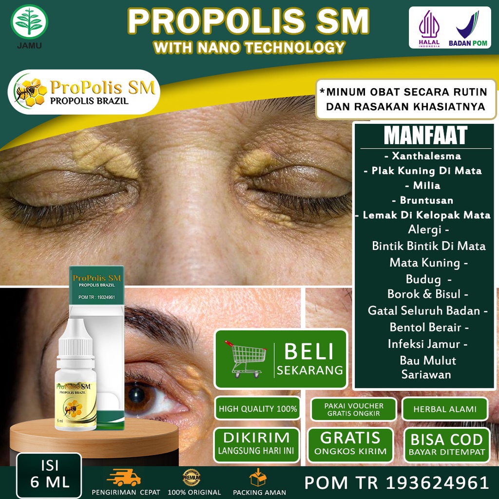 Jual Obat Xantelasma Obat Penghilang Xanthelasma Plak Kekuningan Di ...