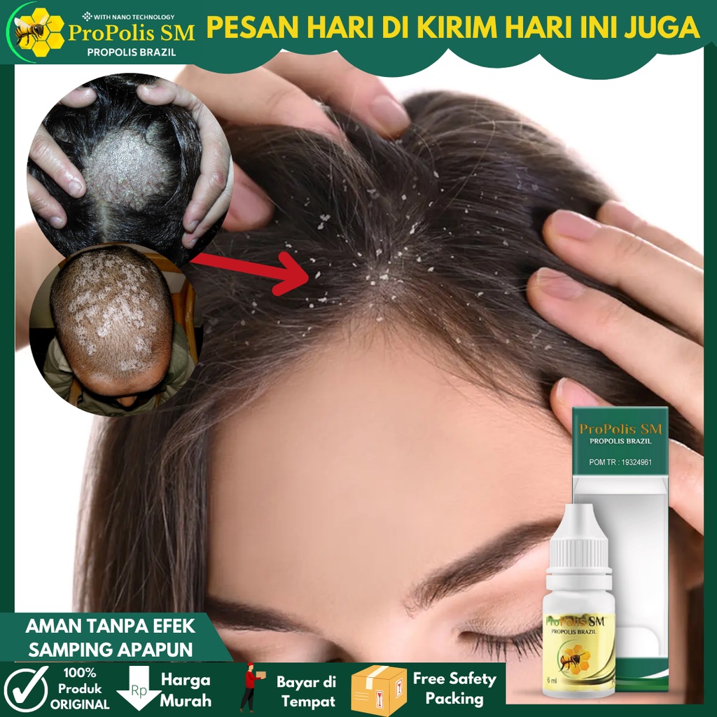 Jual Obat Ketombe Rambut, Obat Jamur di Kepala, Obat Ketombe Kering/ Basah, Obat ketombe ...
