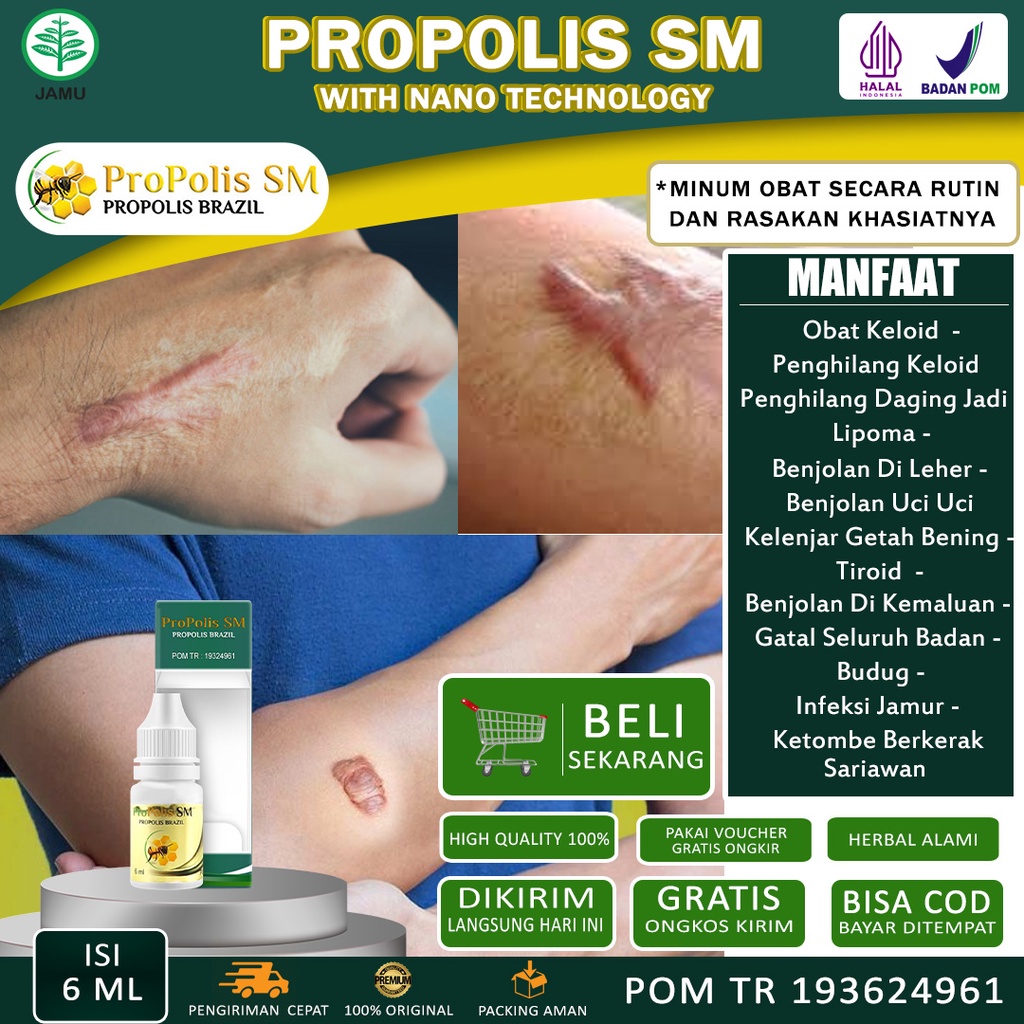 Jual Obat Keloid Daging Tumbuh Penghilang Daging Jadi Bekas Operasi ...