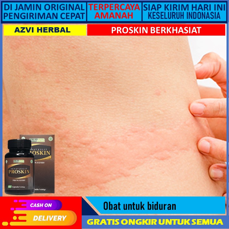 Jual obat biduran obat gatal biduran obat biduran menahun Obat Budug ...