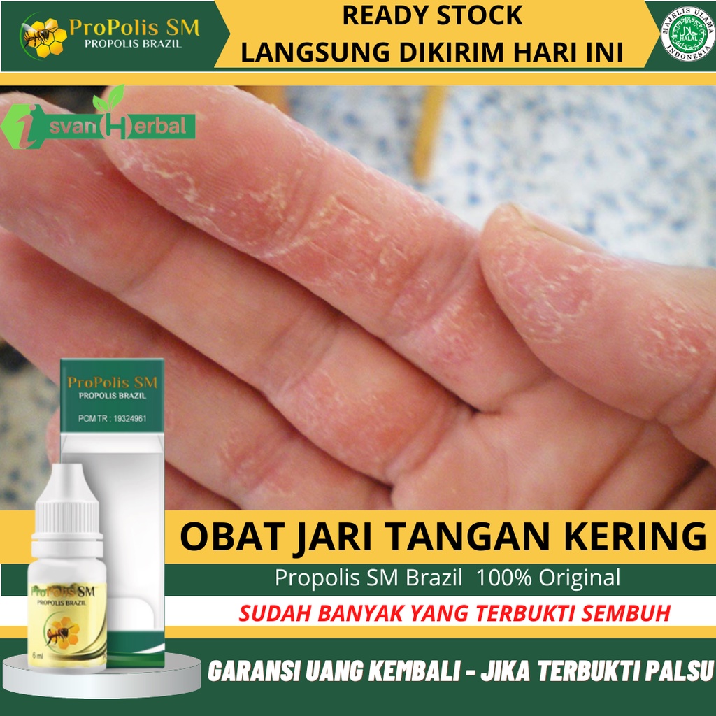 Jual Obat Jari Tangan Pecah Pecah, Telapak Tangan Kasar, Kuman Air ...