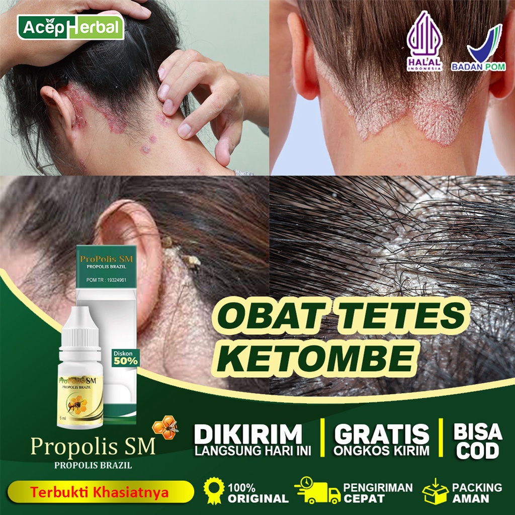 Jual Obat Ketombe Parah Penghilang Koreng di Kepala Rambut Rontok ...