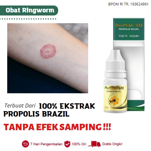 Jual Propolis SM - Obat Ringworm Manusia Infeksi Kulit Jamur Ruam ...
