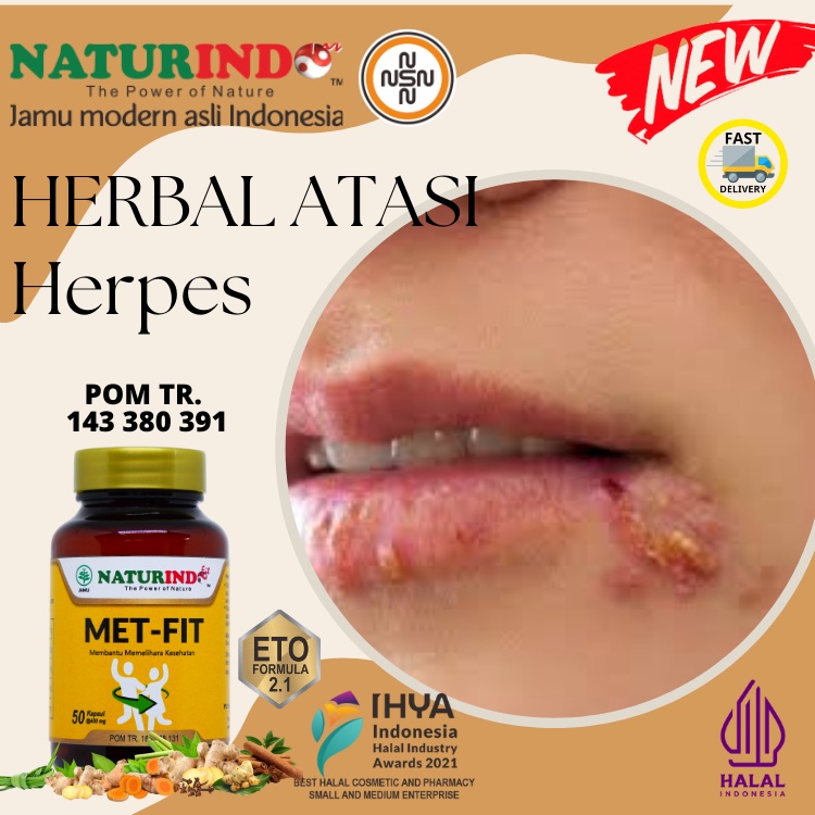 Jual Obat Herpes Cacar Air Benjolan Bernanah Gatal Met Fit Naturindo ...