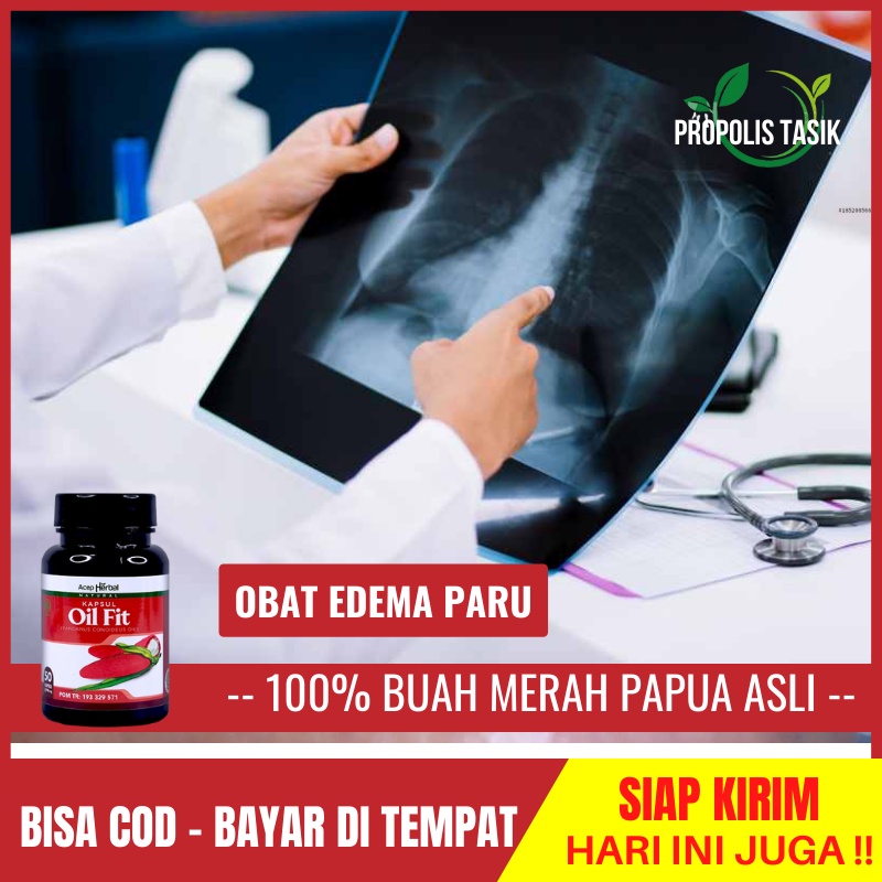 Jual Obat Paru Paru Terendam Cairan, Obat Edema Paru, Obat Paru Paru ...