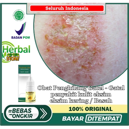 Jual Obat Penghilang Gatel - Gatal & penyakit kulit eksim, eksim kering ...