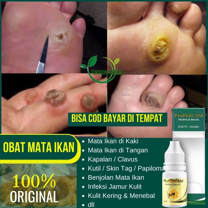 Jual Obat Mata Ikan di Telapak Kaki, Mata Ikan di Kaki & Tangan, Salep ...