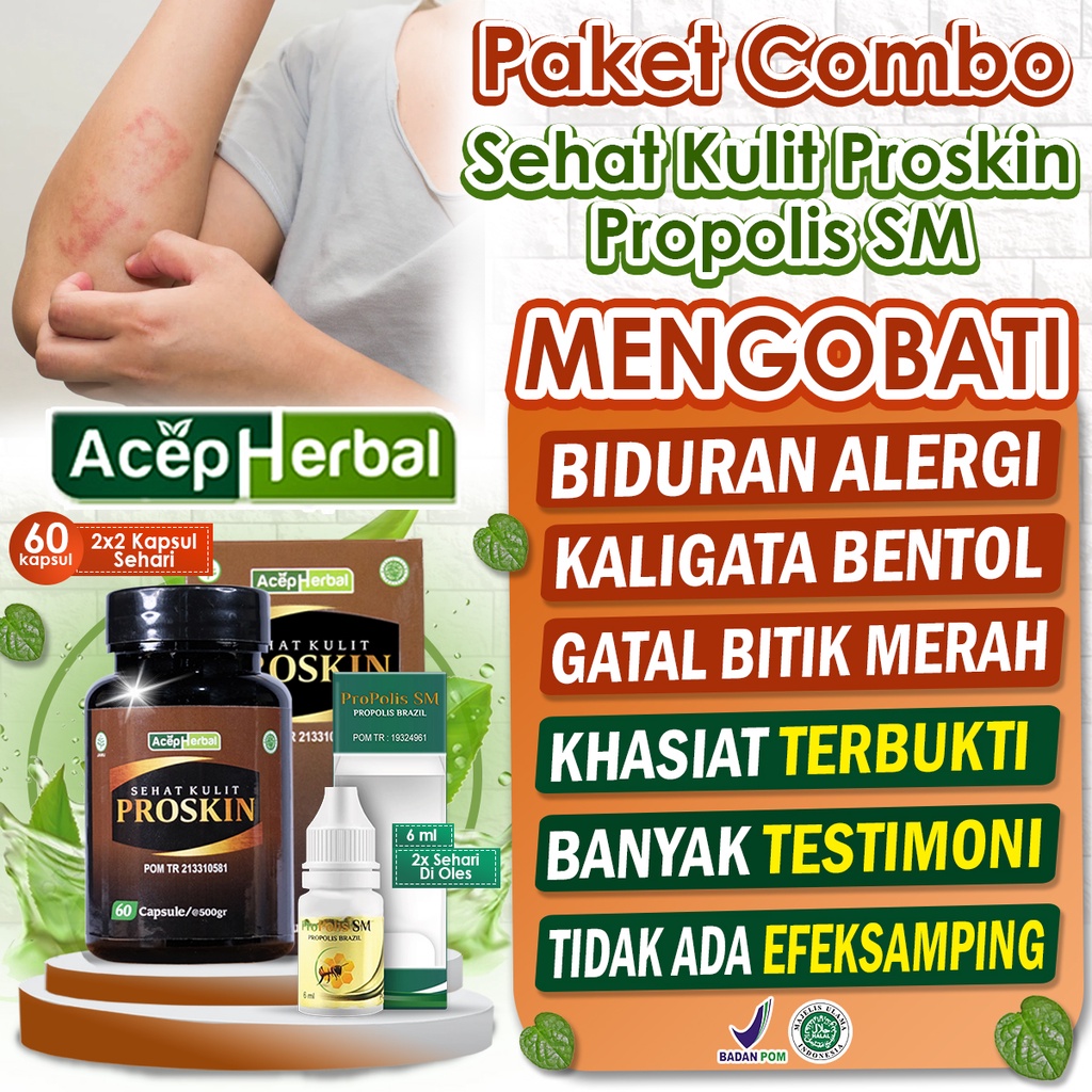 Jual Obat biduran alergi dingin kaligata gatal biang keringat bruntusan ...