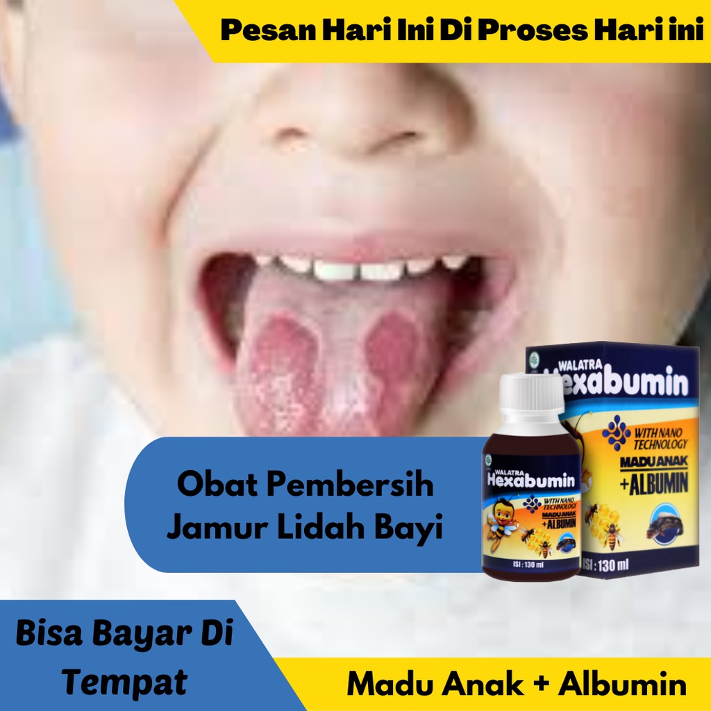 Jual Obat Pembersih Jamur Lidah Bayi , Infeksi Candida Albicans , Lidah Anak Berjamur ...