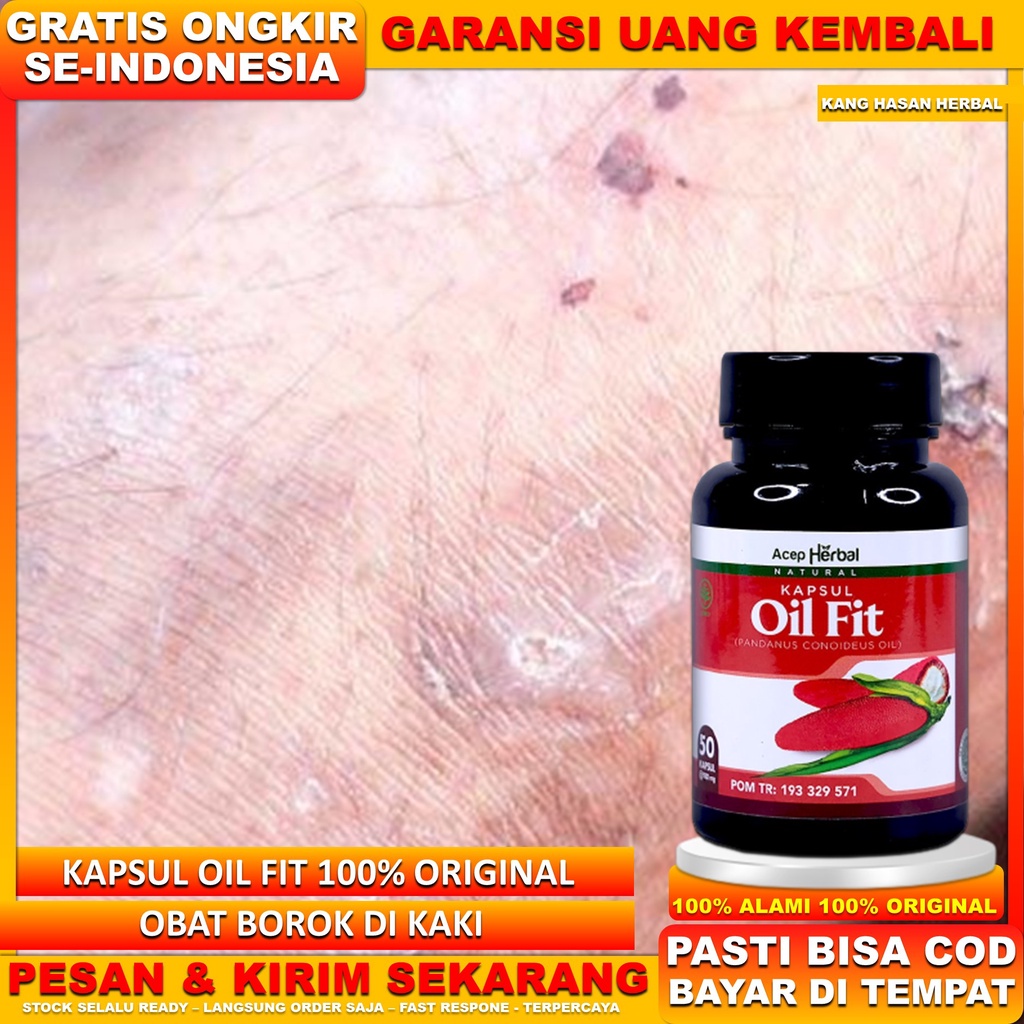 Jual Obat Budug Di Kaki Budug Gatal Budug Santri Budug Bernanah Cenang ...