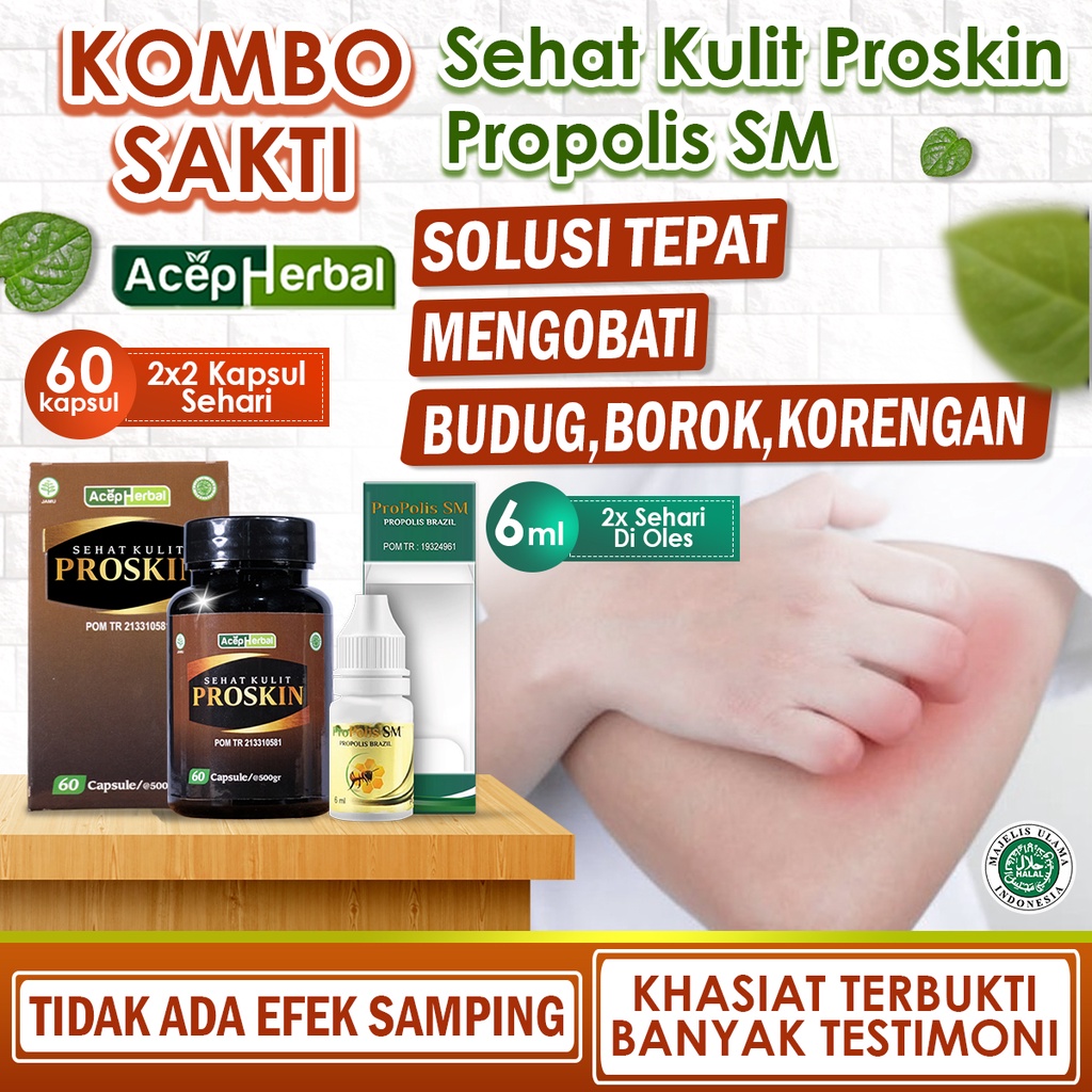 Jual PROSKIN Obat Budug Seluruh Badan Gatal Penghilang Korengan Scabies ...