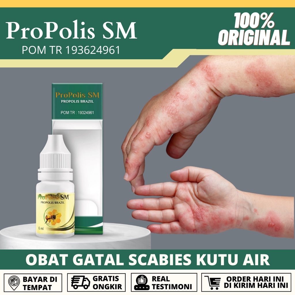 Jual ProPolis SM Obat Salep Eksim Kering, Eksim Basah, Eksim Menahun ...