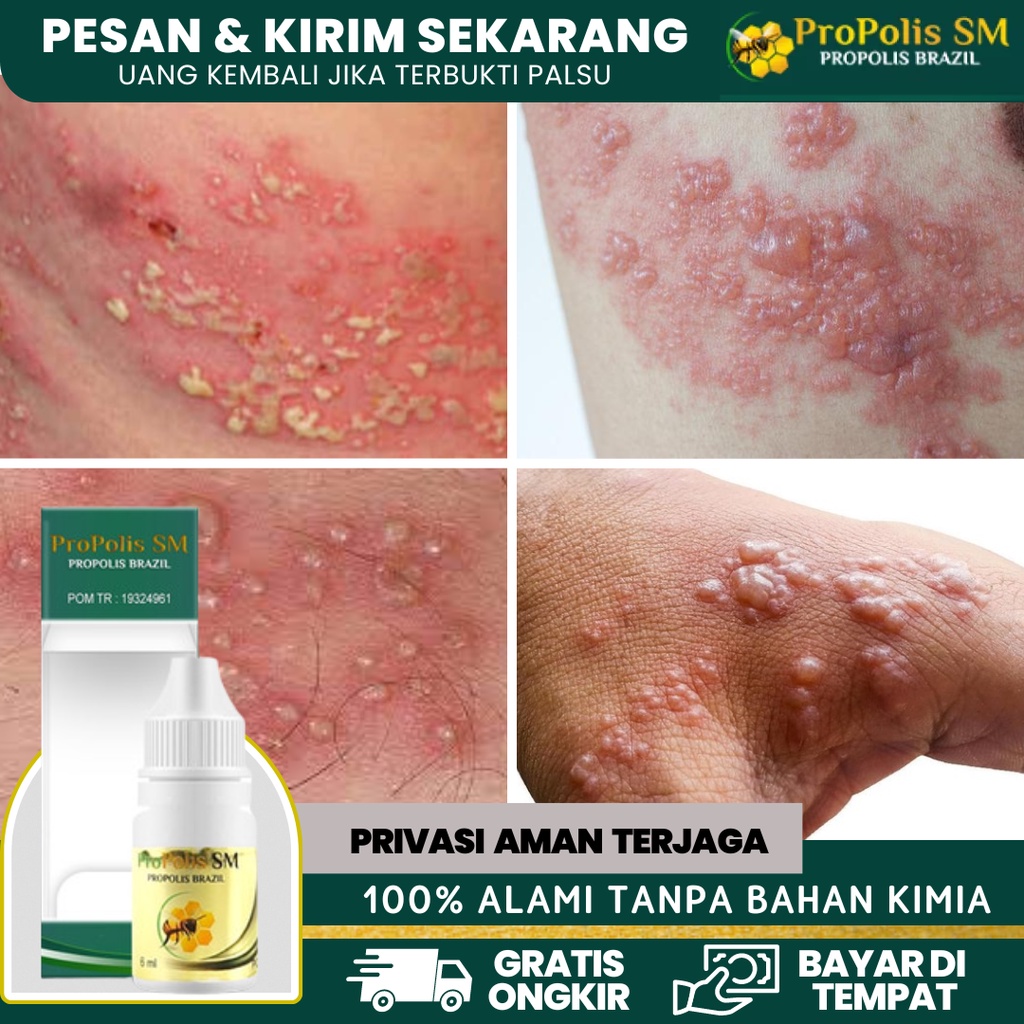 Jual Obat Cacar Air Anak - Obat Cacar Air Dewasa - Obat Cacar Air Bayi ...