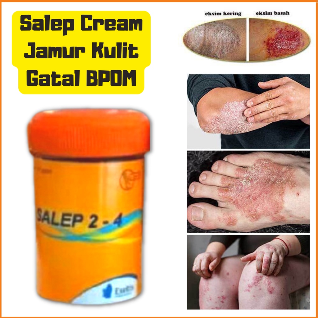 Jual [ Cream salep 24 ] Obat Panu Paling Ampuh Asli Salep Gatal Alergi ...