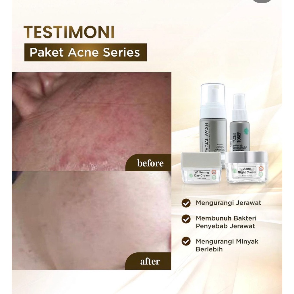 Jual Orderan Kak Eva (Acne Series) | Shopee Indonesia