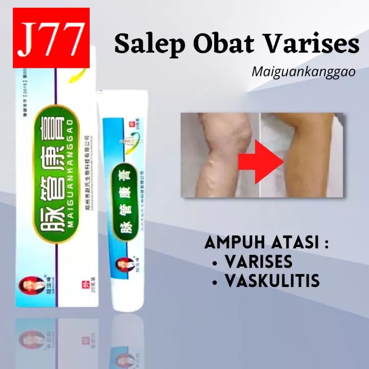 Jual Salep Varises Obat China Maiguankanggao Obat Varises Bengkak ...