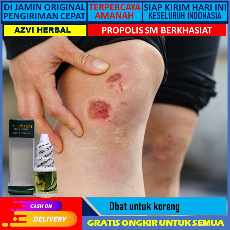 Jual obat koreng obat korengan Obat Koreng Obat Koreng Di Kaki Salep ...